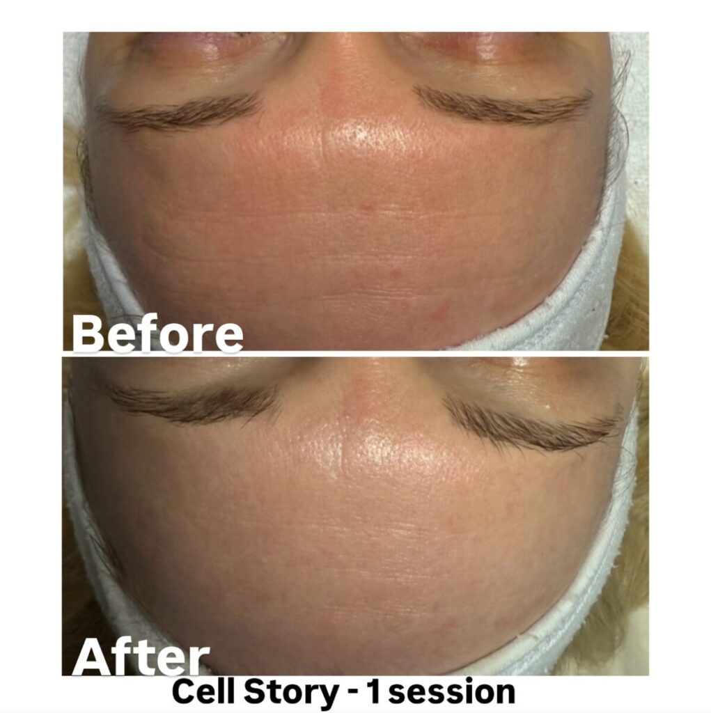 Cell Story Liquid Microneedling in Madison, NJ - Beneath the Surface Spa